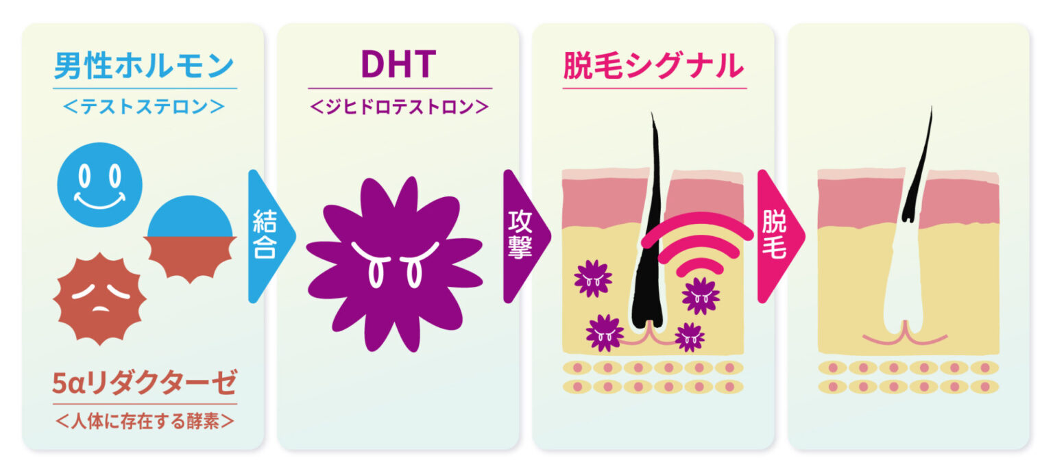 AGAの基礎知識：図解でわかりやすく解説 - 表参道メディカルクリニック